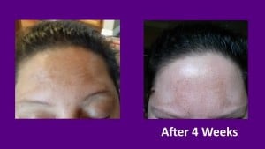 Sun damage forehead | MomMomOnTheGo